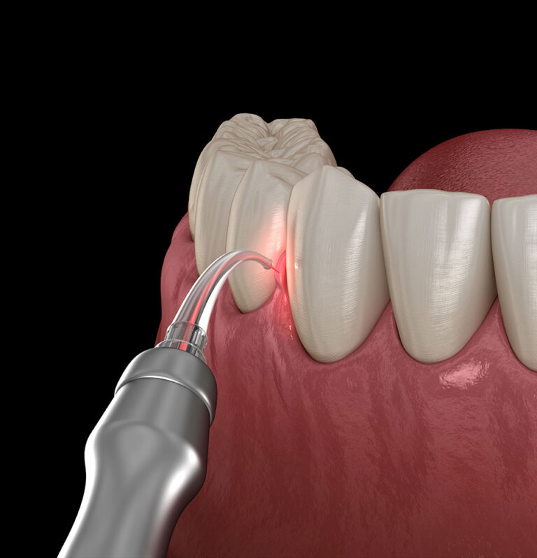 LANAP® Laser Gum Surgery | Greenacres, FL | Ferber Dental